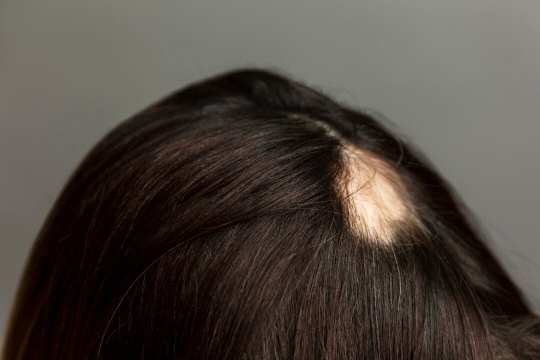 My Hair Is So Thin I Can See My Scalp - What Should I Do?