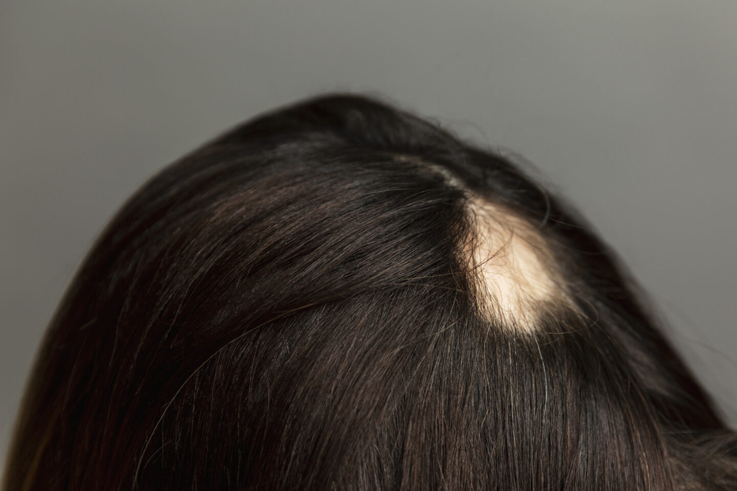 My Hair Is So Thin I Can See My Scalp - What Should I Do?