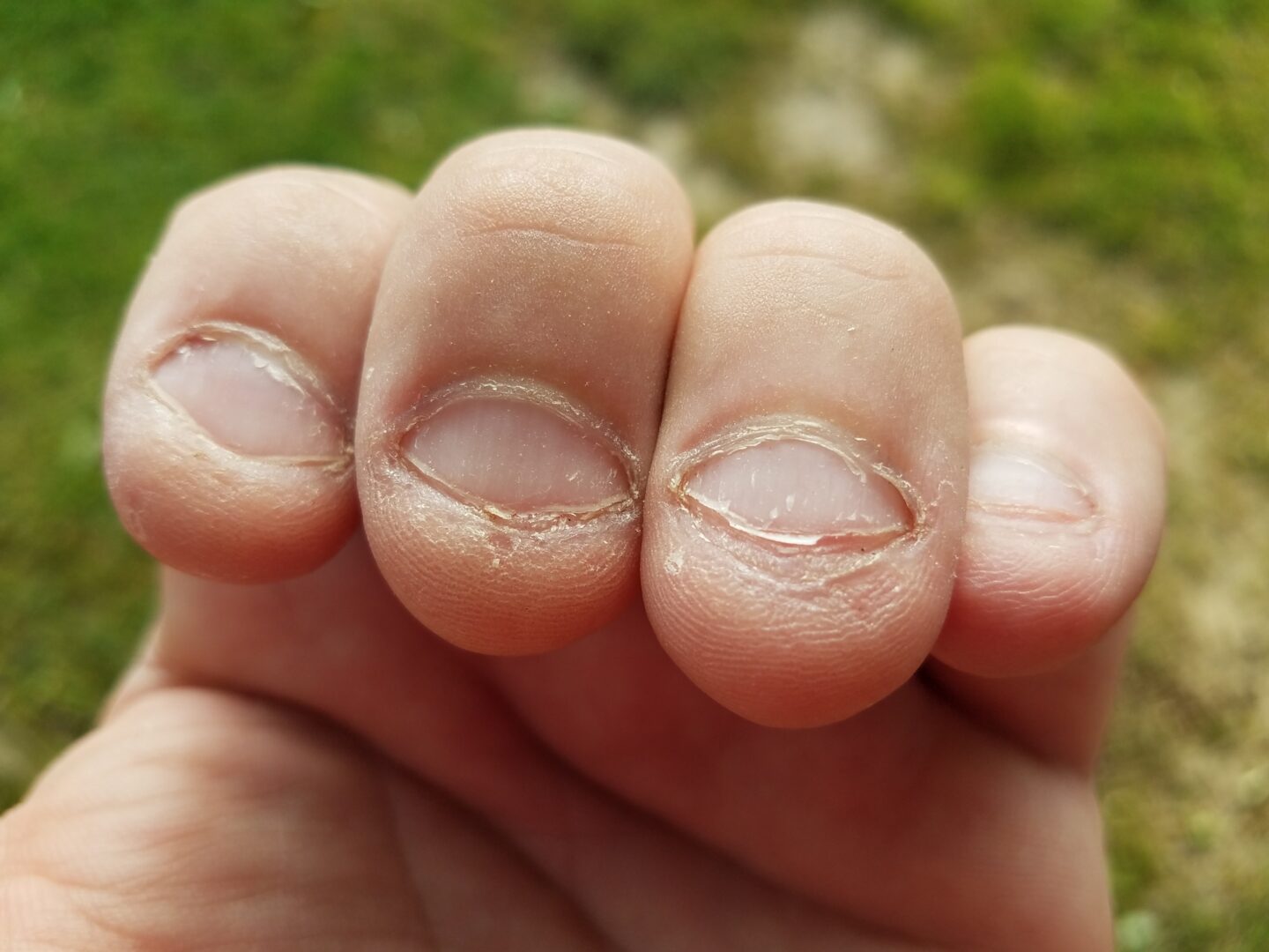 Hope For Nail Biters? Can Bitten Nails Grow Back To Normal?