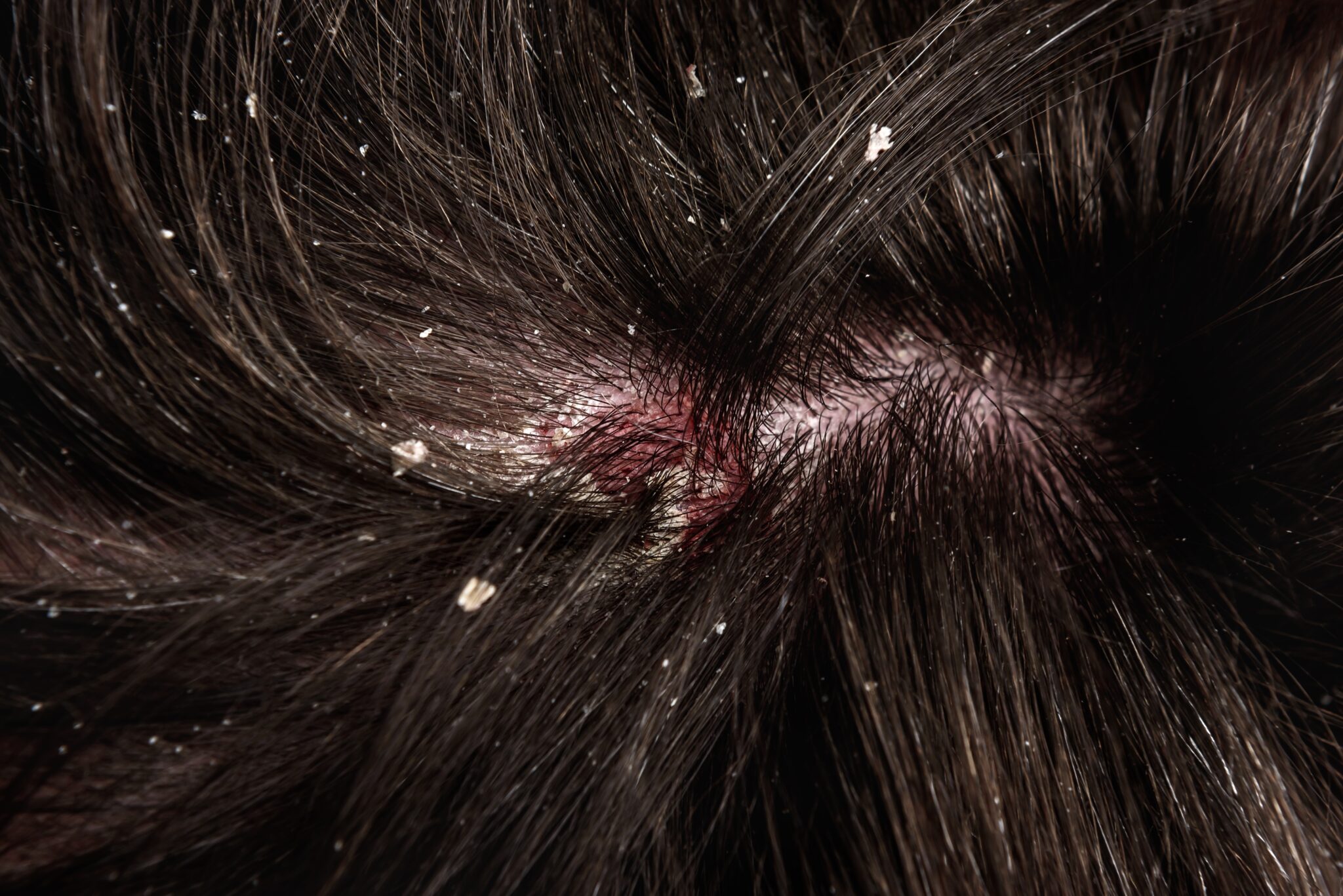 Say Goodbye To Scalp Fungus: Is Baking Soda The Secret Weapon You Need?
